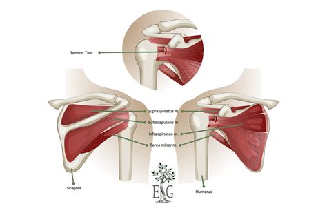 How To Tell If You Have A Rotator Cuff Tear Dr Eric Giang