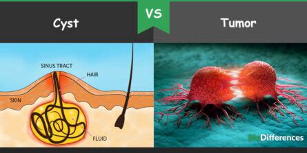 Difference Between Cyst And Tumor Bio Differences