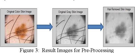 figure 3 from a method for melanoma skin cancer detection using