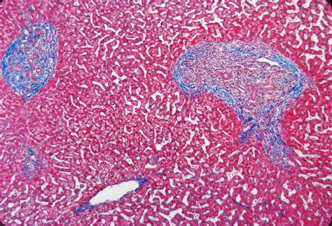 Liver Fibrosis Light Micrograph Stock Image C0566969 Science