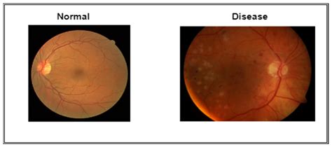 Mild Hypertensive Retinopathy