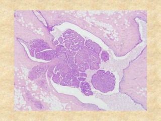 Breast benign neoplasms For MBBS | PPTX