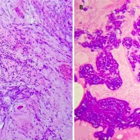 A Non Contrast Ct Scan Showing Extensive Calcification Of The