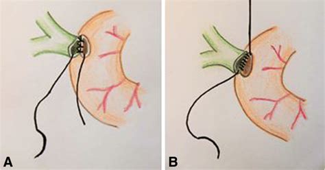 Continuous Or Interrupted Suture Technique For Hepaticojejunostomy A