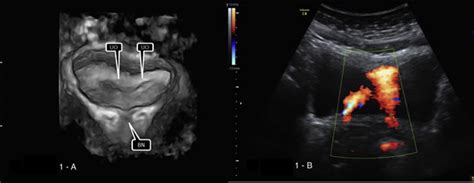 Use Of Ultrasound To Identify And Measure The Female Bladder Trigone