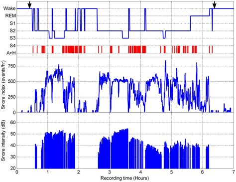 Upper Panel Sleep Stages Throughout The Night And Apneahypopnea Download Scientific Diagram