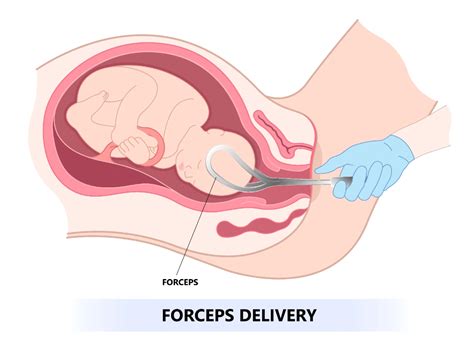 Vaginal Delivery Dr Claudia Chi