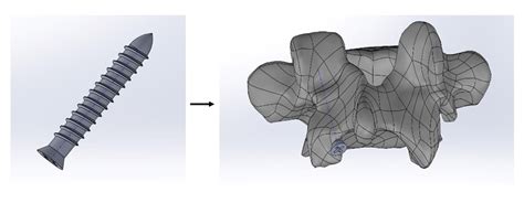 Enhancing Surgical Outcomes In Pars Interarticularis Fracture An Investigation Of Treatment