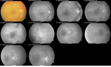 An 82 Year Old Man With Transient Visual Disturbance Of The Right Eye