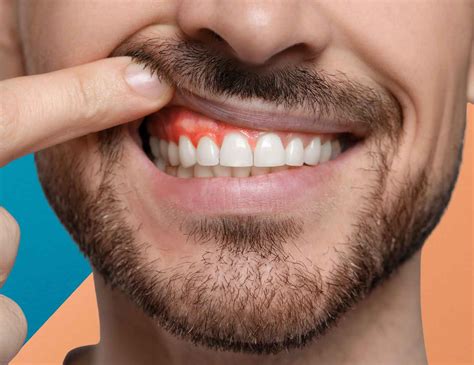 When A Tooth Abscess Becomes An Emergency Clove Dental