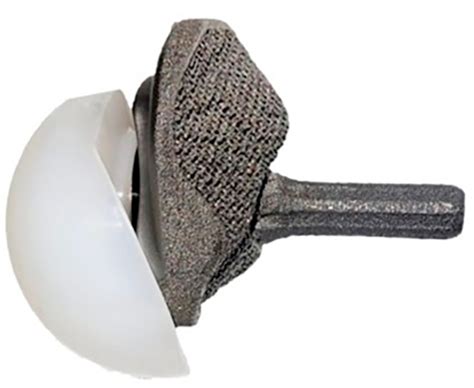Future Advances In Shoulder Arthroplasty Surgery Journal Of Clinical