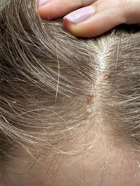 Dandruff Buildup Dry Scalp Seb Derm Rsebderm