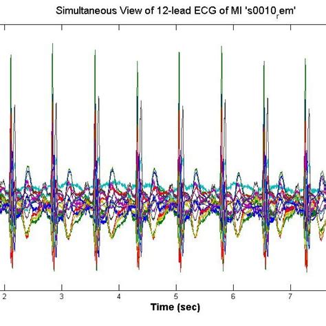 Detection Of Mi From Multilead Ecg Wavelet Transform Download Scientific Diagram