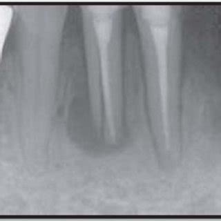 PDF Vertical Root Fracture A Dilemma Revisited