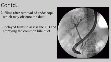 Procedure Of Ercp And T Tube Cholangiography PPTX