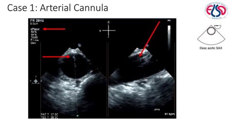 2 Advanced Ecmo Management Strategiespdf Heart And Cardiovascular