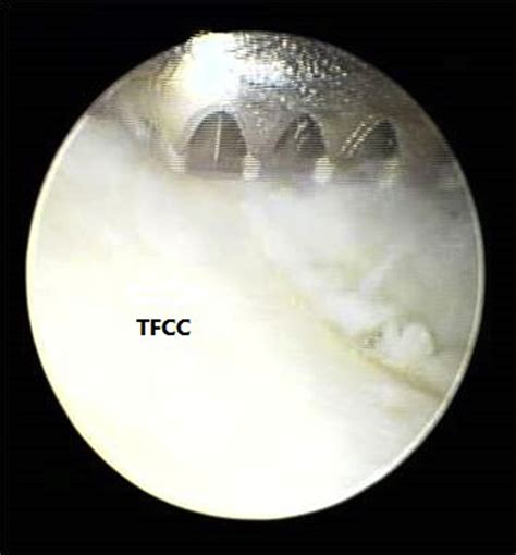 Arthroscopic Treatment Of Type 1b Triangular Fibrocartilage Complex Tear By “outside In” Repair