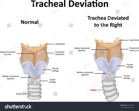 4 Imágenes De Tracheal Deviation Imágenes Fotos Y Vectores De Stock