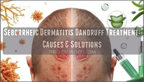 Natural Home Remedies For Seborrheic Dermatitis Dandruff Relief