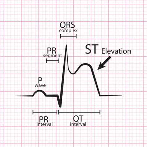 Acs And Stemi Systems Of Care Acls Resources Acls Certification