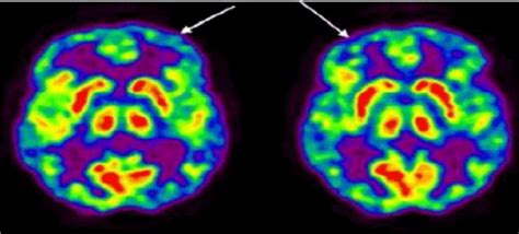 Figure 3 Fdg Pet Scan Of Patient