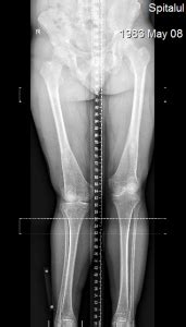 Genu Valgum Congenital