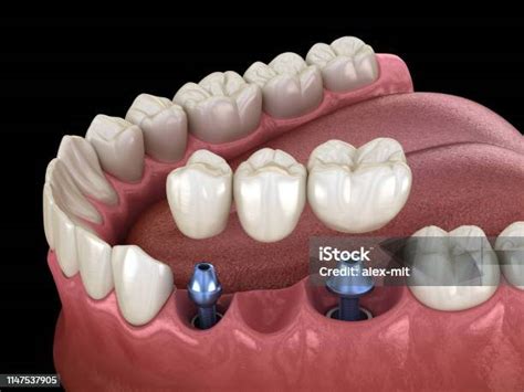 임 플 란 트가 지 원하는 치과 교량 인간의 치아와 의치 개념의 의학적으로 정확한 3d 그림 임플란트에 대한 스톡 사진 및 기타 이미지 Istock