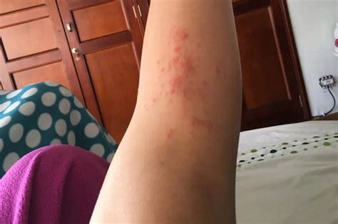 Hookworm Rash In Humans