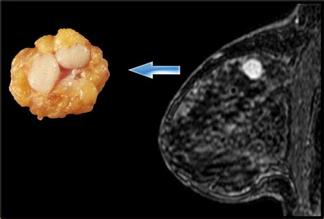 The Radiology Assistant Breast Mri