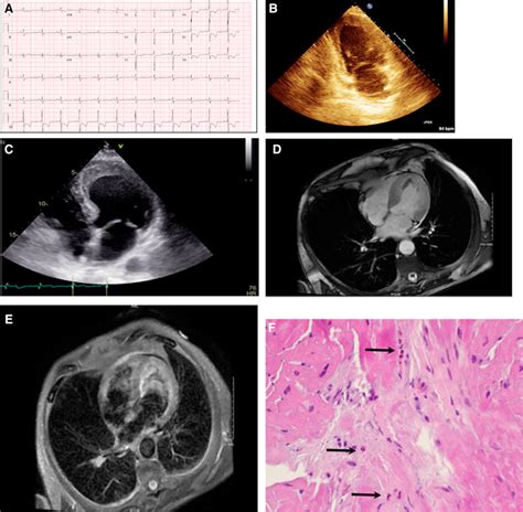 Myocarditis Yer Robson