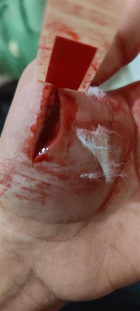 Injury Using Chisel R MedicalGore