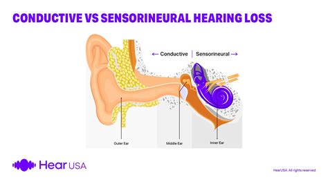 Sensorineural Vs Conductive Hearing Loss Explained