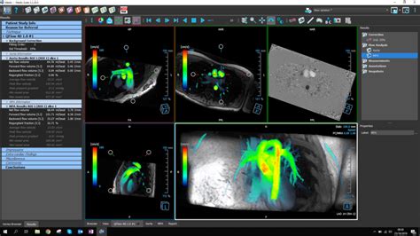 4d Flow Interface Medisimaging