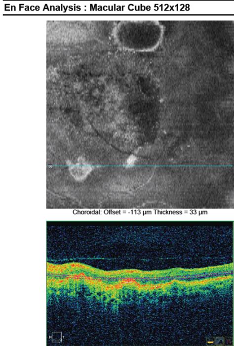 Optical Coherence Tomography In Age Related Macular Degeneration