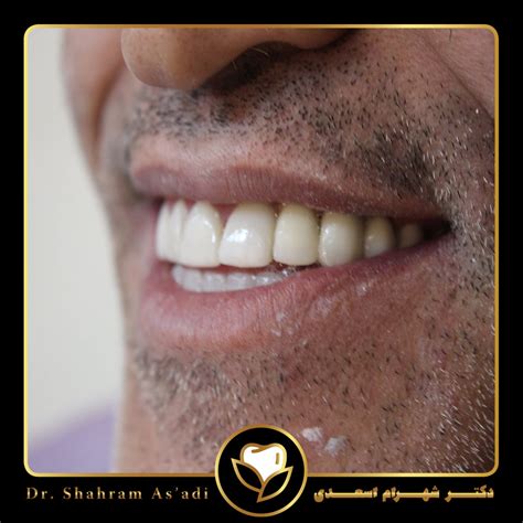 ایمپلنت دیجیتال بهترین روش کاشت دندان، دقیق و سریع با دکتر شهرام اسعدی