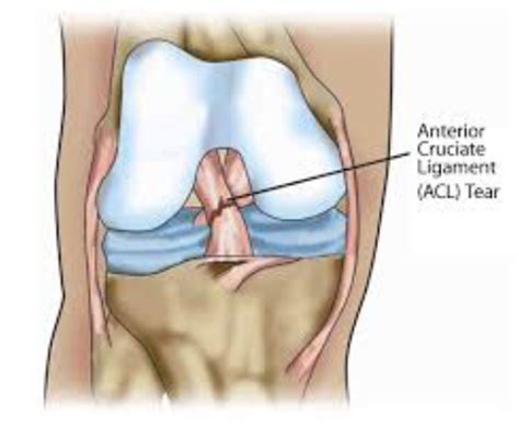 Anterior Cruciate Ligament Reconstruction Dr Peter Walker