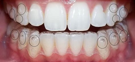 Whitening Teeth With Invisalign Attachments At Robert Parsley Blog