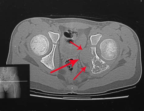 Ewing Sarcoma Of The Pelvis Oncosurgery