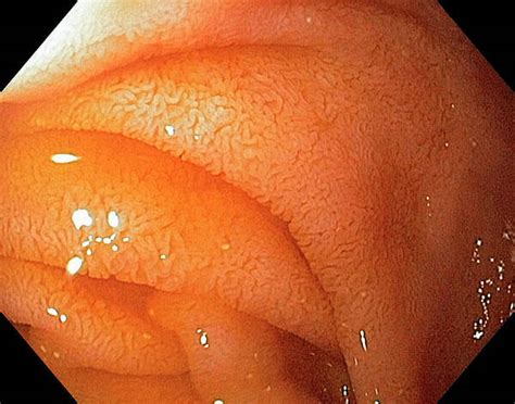 Normal Duodenum Art Print By Science Photo Library Science Photo Gallery