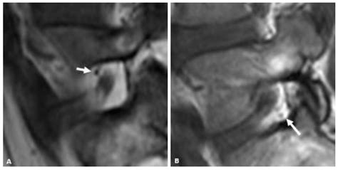 The Composition Of The L5 S1 Neural Foramen On Mri—a Retrospective