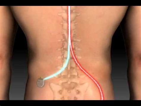 Spinal Cord Stimulation SCS YouTube