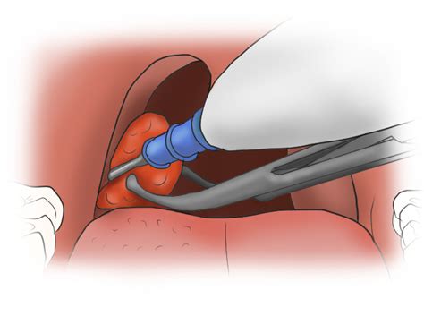 Tonsillectomy Stitches Uvulopalatopharyngoplasty What You Need To