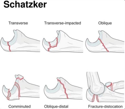 What Is The Schatzker Classification Orthopedic Implants