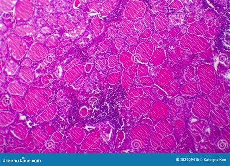 Simple Goiter Light Micrograph Royalty Free Stock Image 253911376