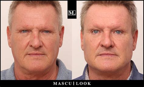 Hyaluronbehandlung für den Mann | Mascu Look | Dr. Djalaei