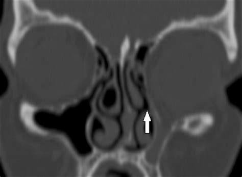 Coronal Ct Slice With Bone Window Settings Showing Atelectasis Of The