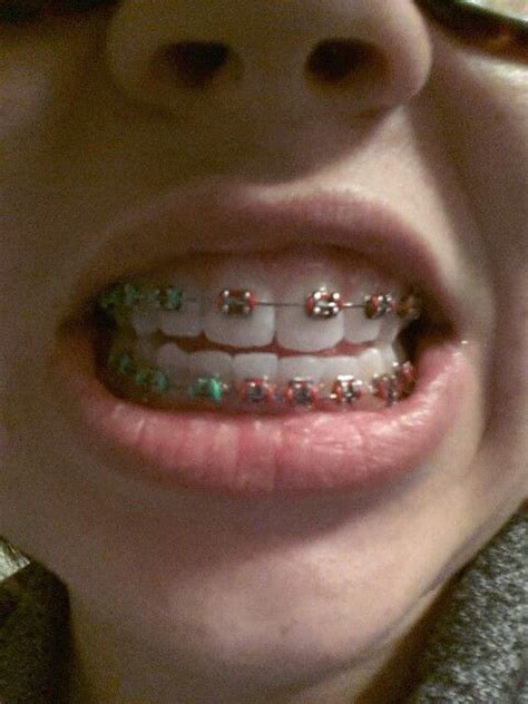 Pink And Green Braces