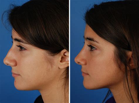 Effective Tips For Managing And Reducing Rhinoplasty Scars