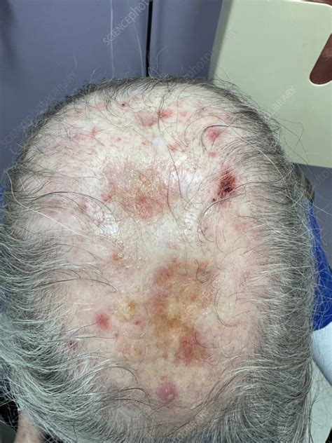 Erosive Pustular Dermatosis Of The Scalp Stock Image C0605897