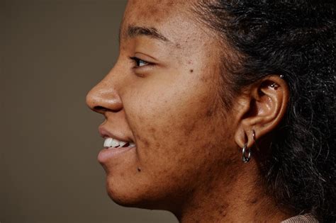 Premium Photo | Close up smiling black woman with acne scars on face real skin texture